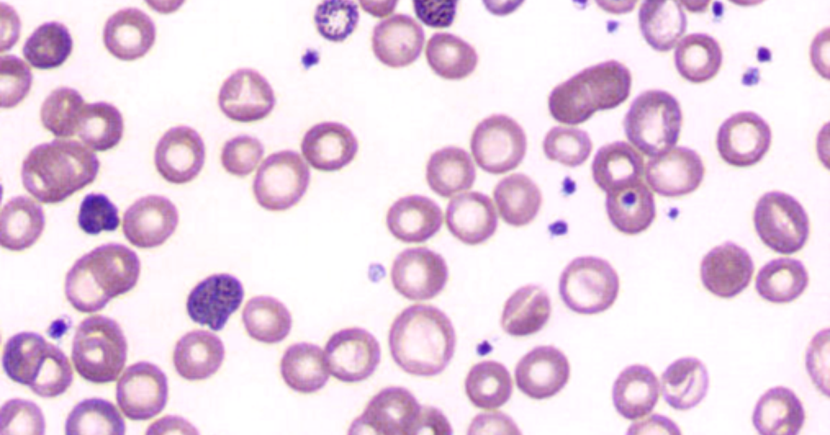 SA Pathology • Lead poisoning - know the symptoms